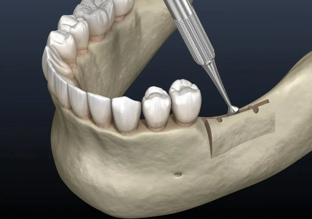 Ridge Augmentation San Diego CA | Dental Bone Graft Del Mar CA